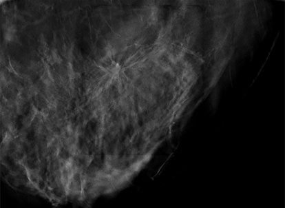 Affirm® Prone Breast Biopsy System | Hologic