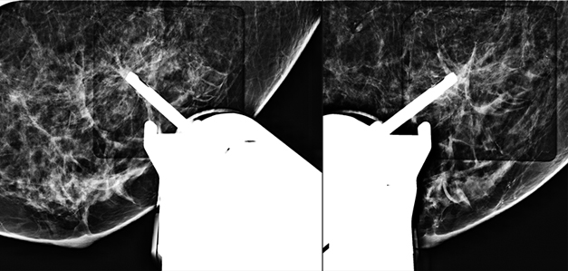 Affirm® Prone Breast Biopsy System | Hologic