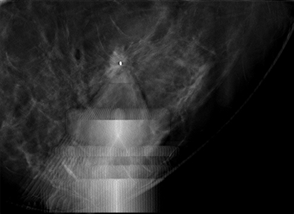 Affirm® Prone Breast Biopsy System | Hologic
