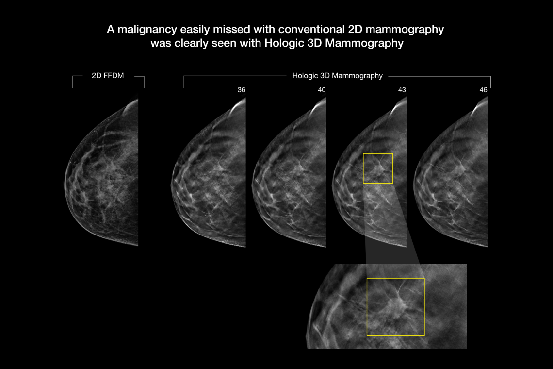 Hologic Selenia Dimensions Mammography System
