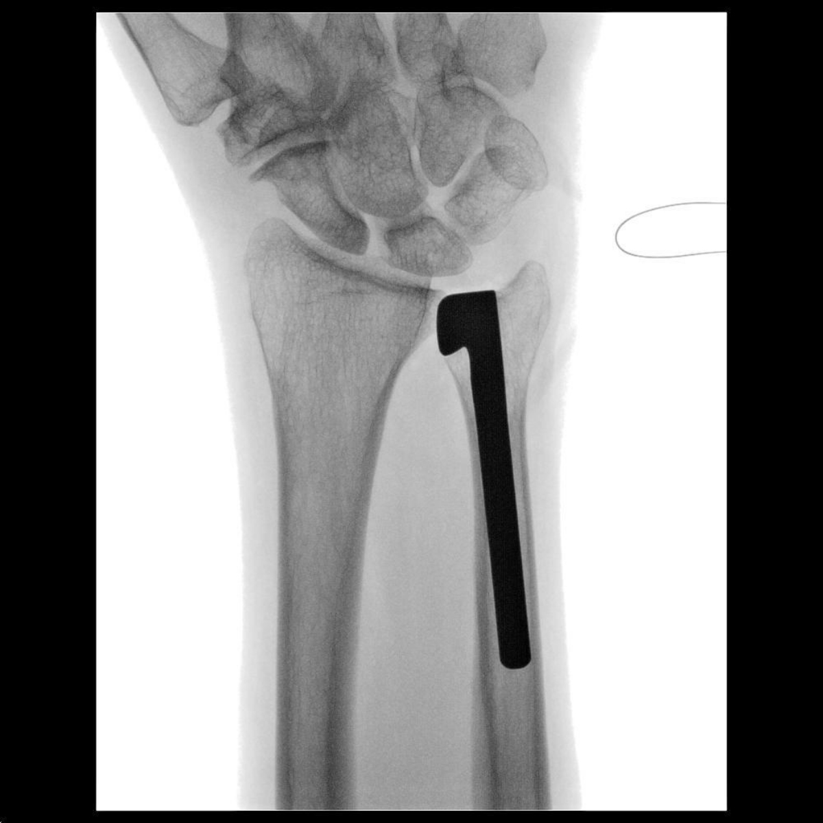 Fluoroscan® InSight® Mini C-arm Extremities Imaging System | Hologic