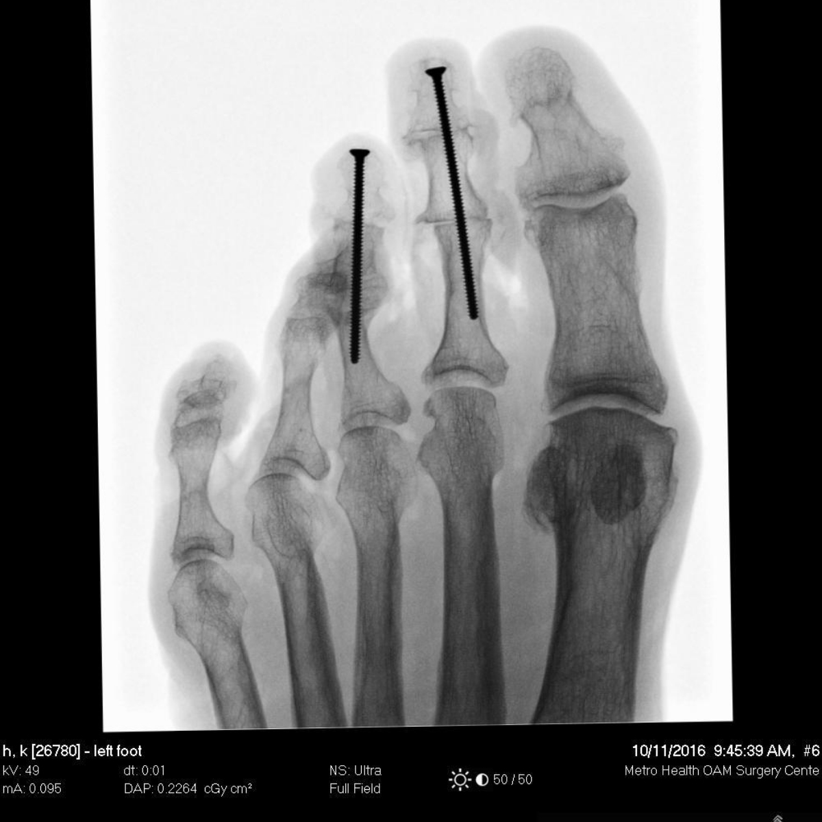 Fluoroscan® InSight® Mini C-arm Extremities Imaging System | Hologic