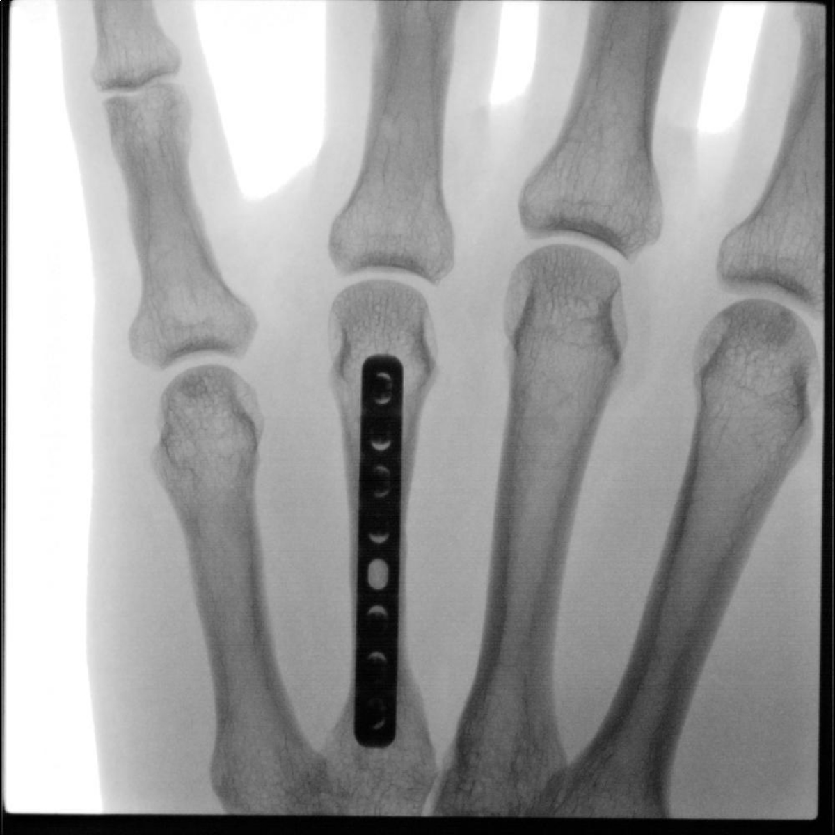 Fluoroscan® InSight® Mini C-arm Extremities Imaging System | Hologic